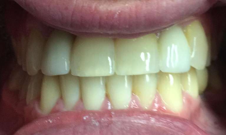 Before And After Photos Mini Implants Gallery Harris Park Nsw